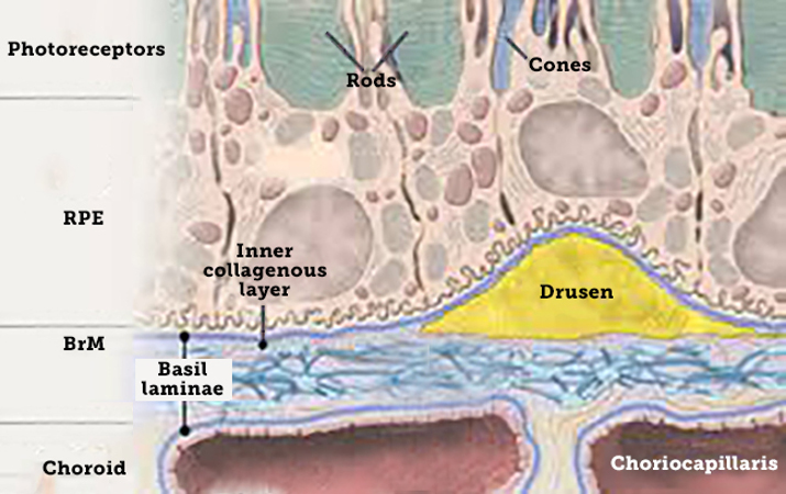 Tratamiento efectivo para las drusas en los ojos: descubre más aquí